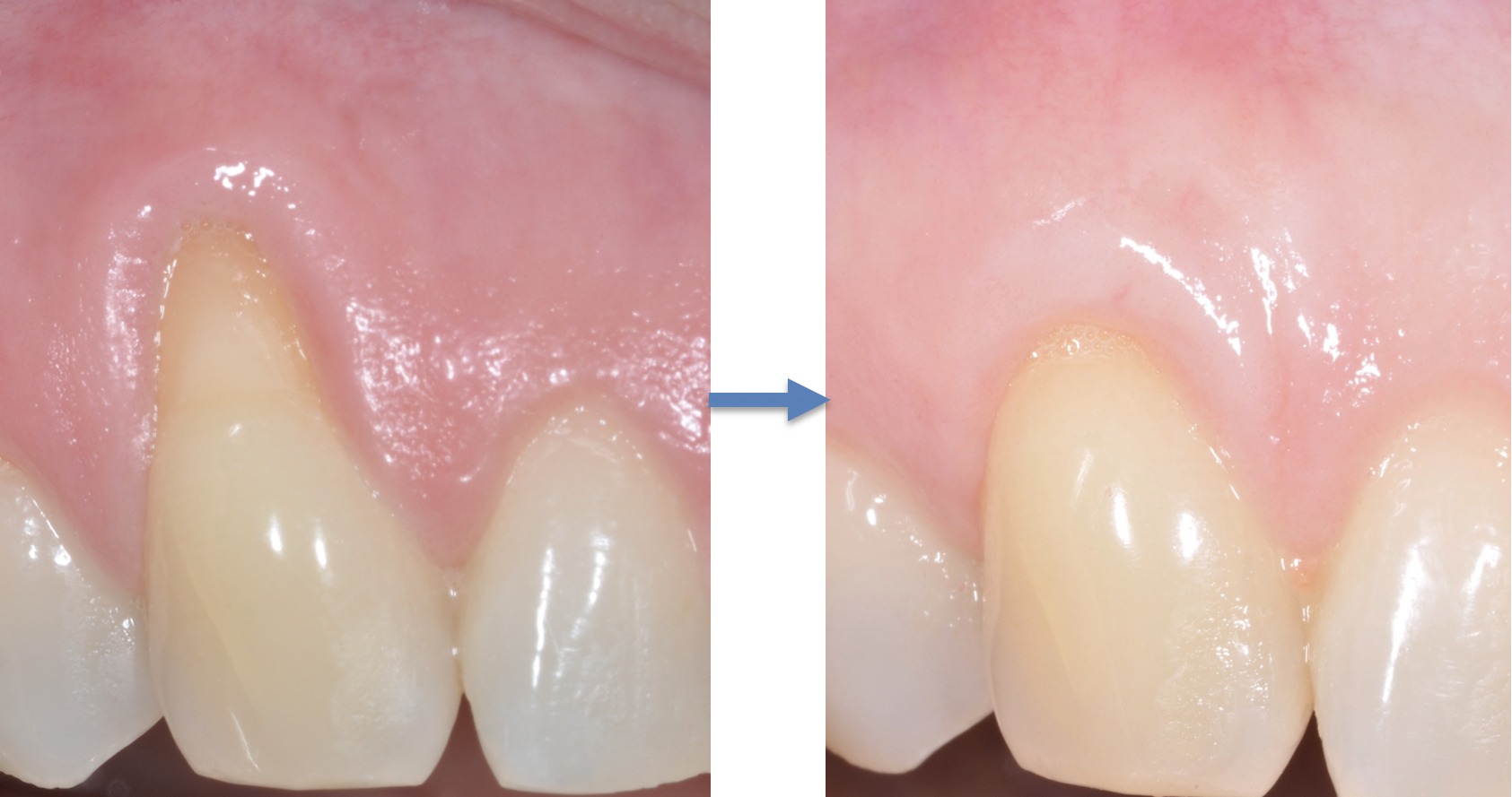 Greffe de gencive et procédure gingivale esthétique | Spécialistes ...